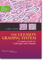 The Gleason Grading System: A Complete Guide for Pathologists and ...